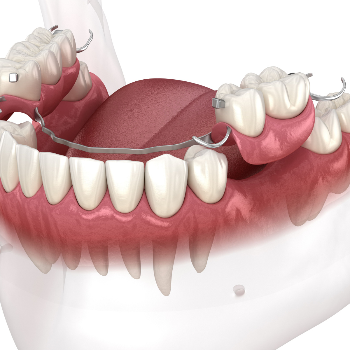 Cost of Dentures in Farmington, NM | Desert Hills Dental Care