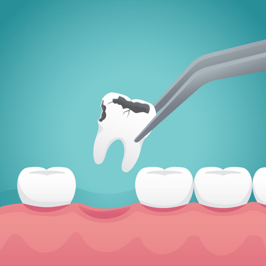 Tooth Extractions & Wisdom Teeth | Farmington, NM, Best Dentists Near You