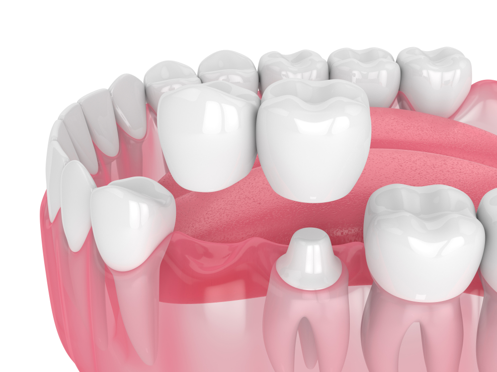 Dental Bridges | Farmington, NM, Best Cosmetic Dentists Near You