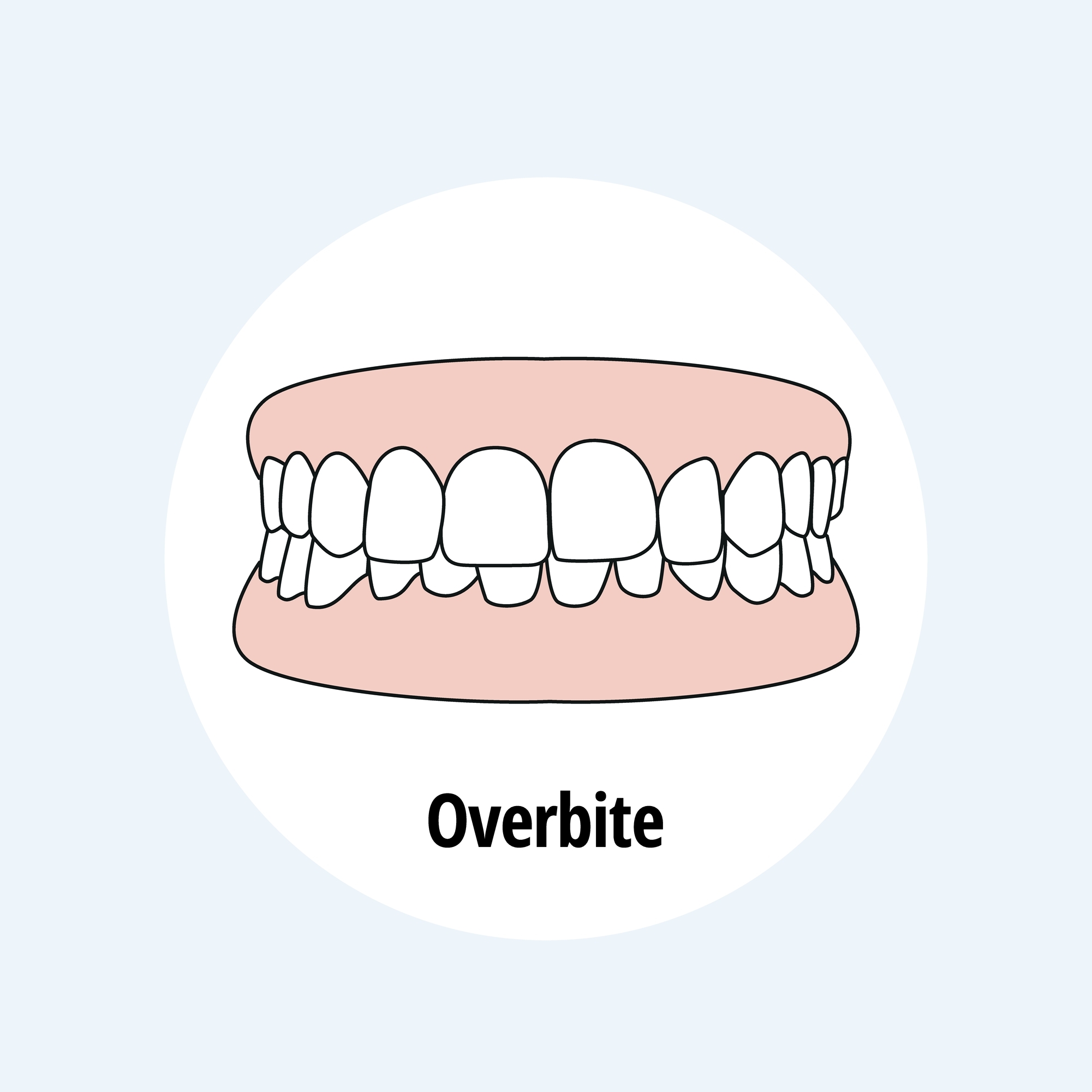 Invisalign for Overbites: Treatment & Benefits | Desert Hills Dental Care